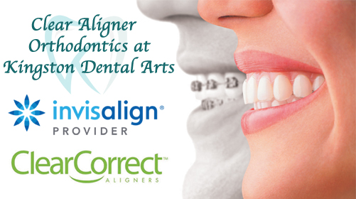 Clear Aligner Orthodontics | Kingston Dental Arts